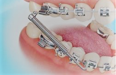 Soorten beugels – Orthodontie Haarlem