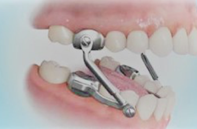 Soorten beugels – Orthodontie Haarlem