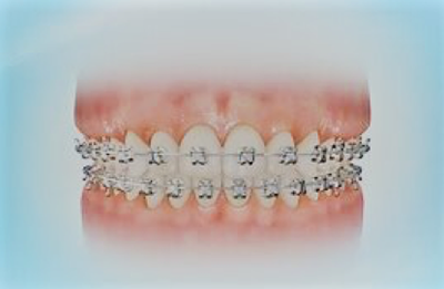 Soorten beugels – Orthodontie Haarlem